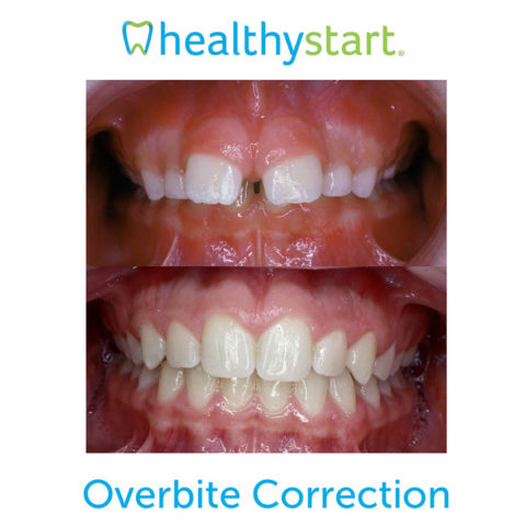 Straight Teeth for Kids - Ecologic Dentistry- The Natural Choice