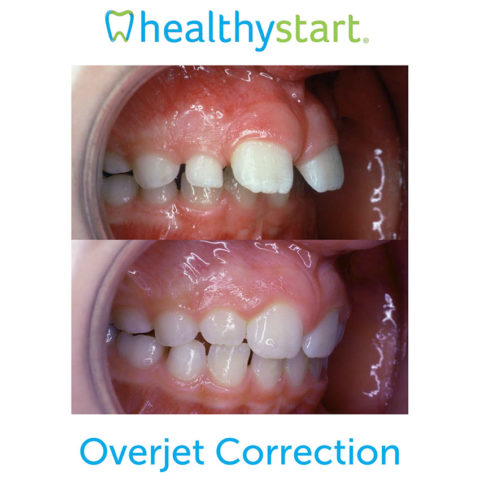 Straight Teeth For Kids Ecologic Dentistry The Natural Choice